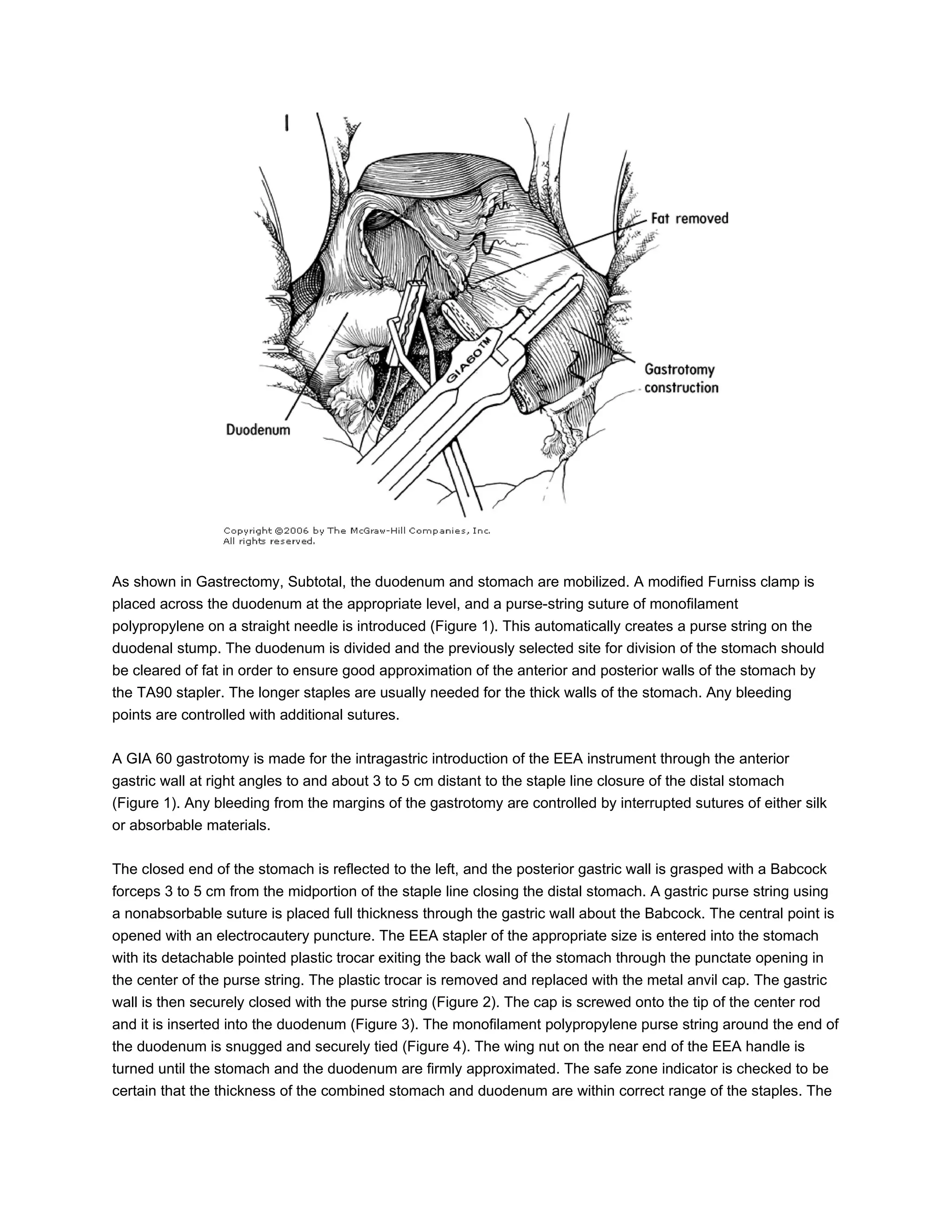 Hemigastrectomy, billroth I stapled | DOC