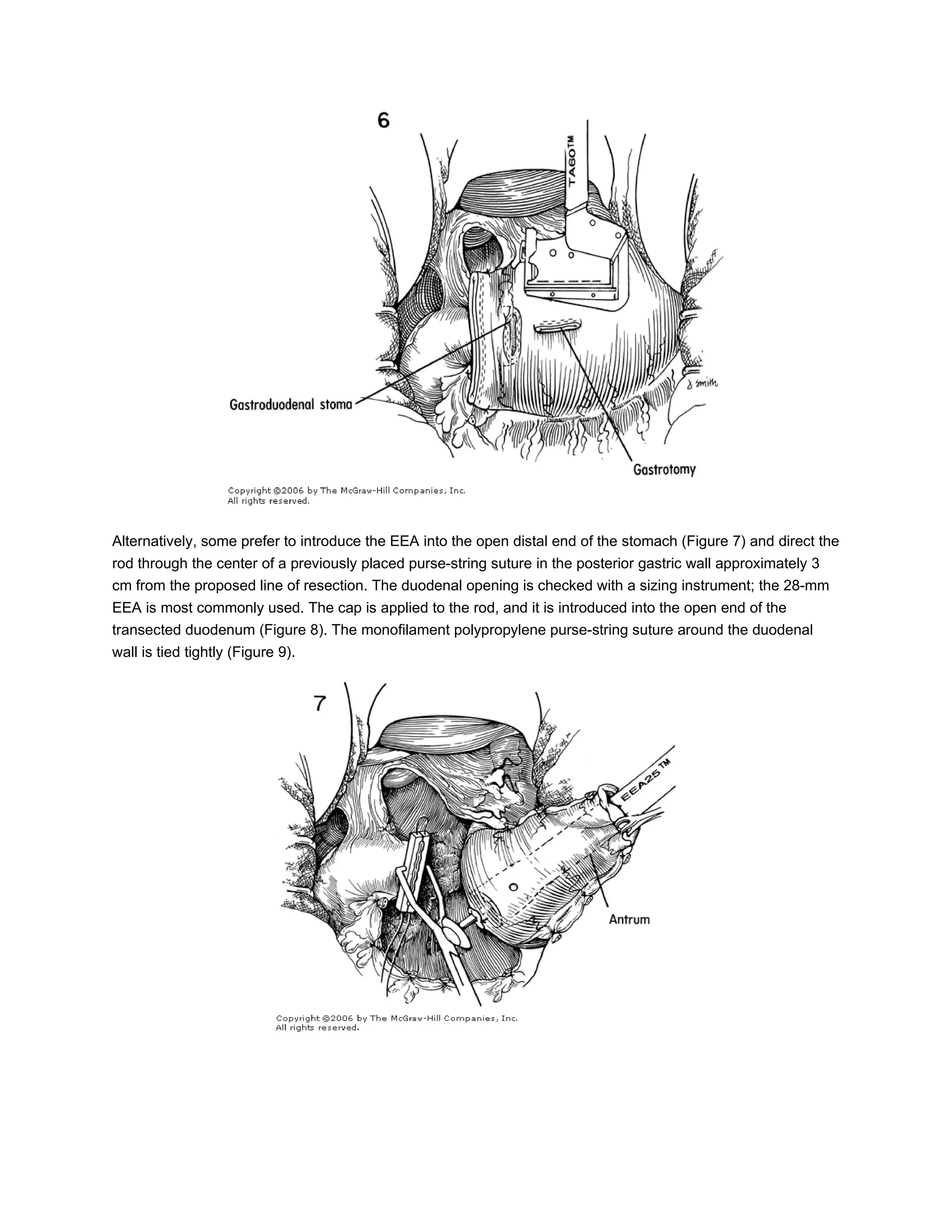 Hemigastrectomy, billroth I stapled | DOC