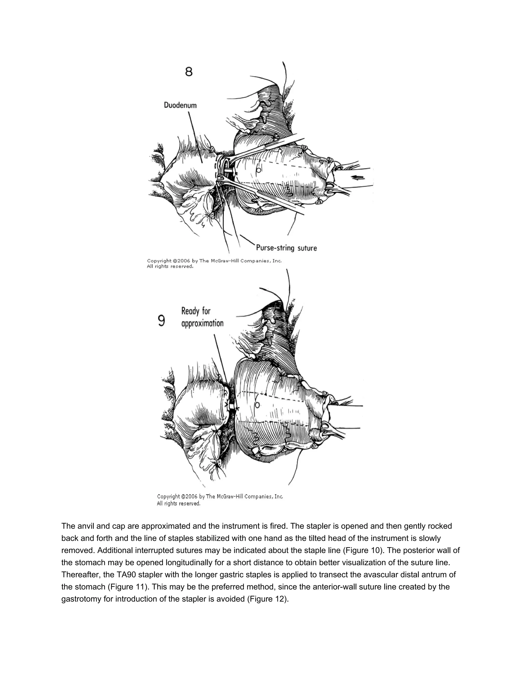 Hemigastrectomy, billroth I stapled | DOC