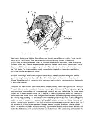 Hemigastrectomy, billroth I stapled | PDF