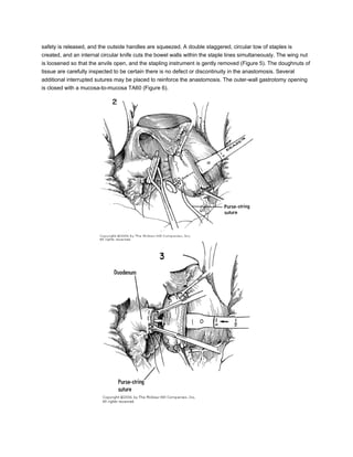 Hemigastrectomy, billroth I stapled | DOC