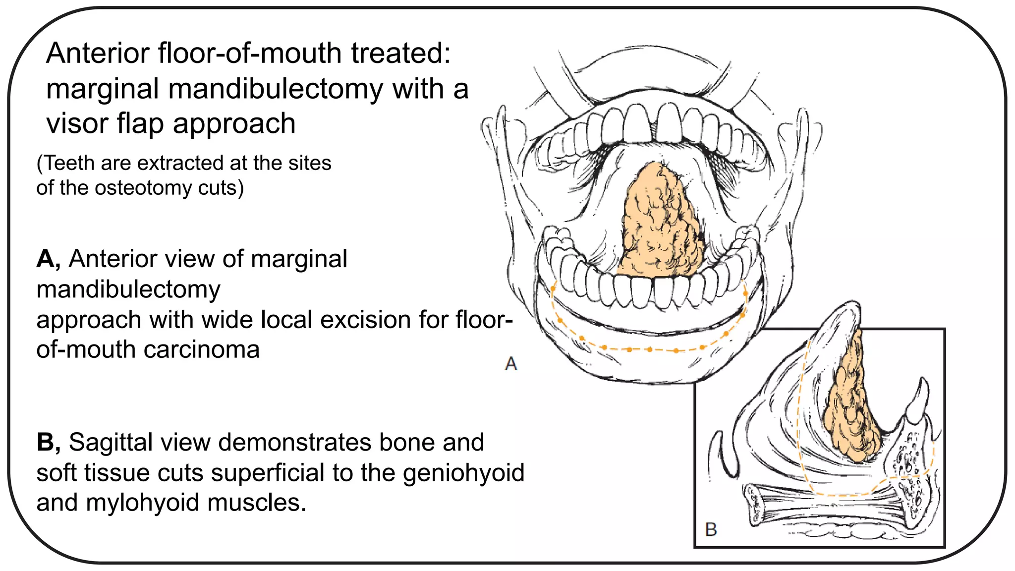 Hemiglossectomy and mandibulectomy Dr. M.Erami | PPTX