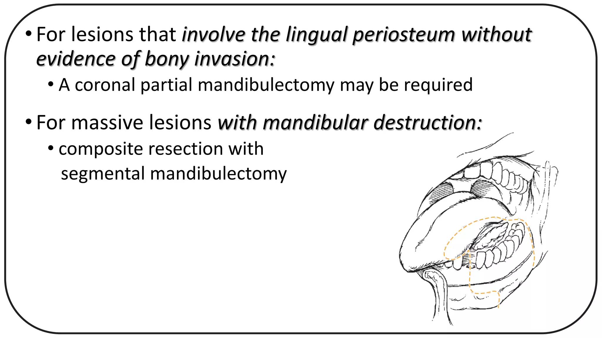 Hemiglossectomy and mandibulectomy Dr. M.Erami | PPTX