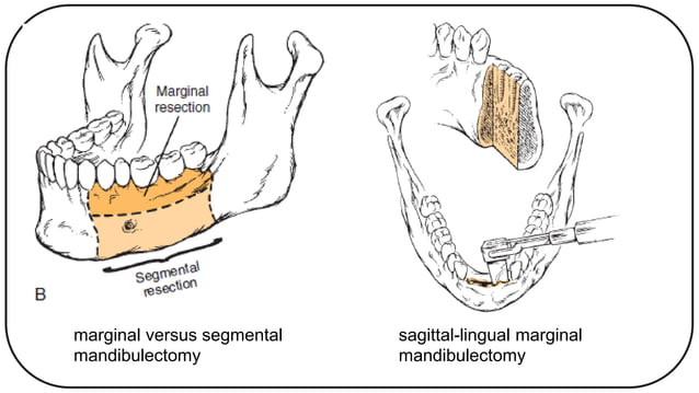 Hemiglossectomy and mandibulectomy Dr. M.Erami