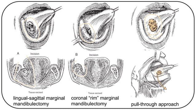 Hemiglossectomy and mandibulectomy Dr. M.Erami