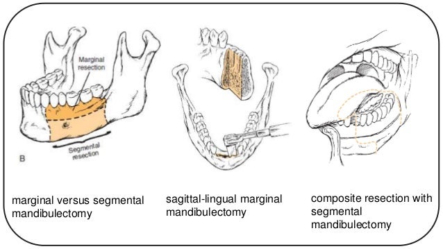 Hemiglossectomy and mandibulectomy Dr. M.Erami