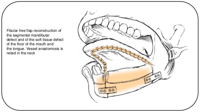 Hemiglossectomy and mandibulectomy Dr. M.Erami