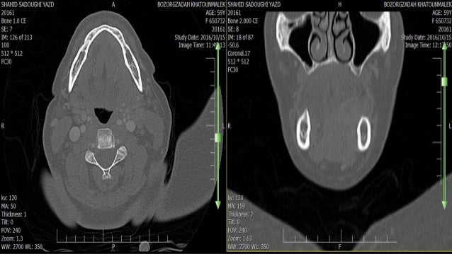 Hemiglossectomy and mandibulectomy Dr. M.Erami