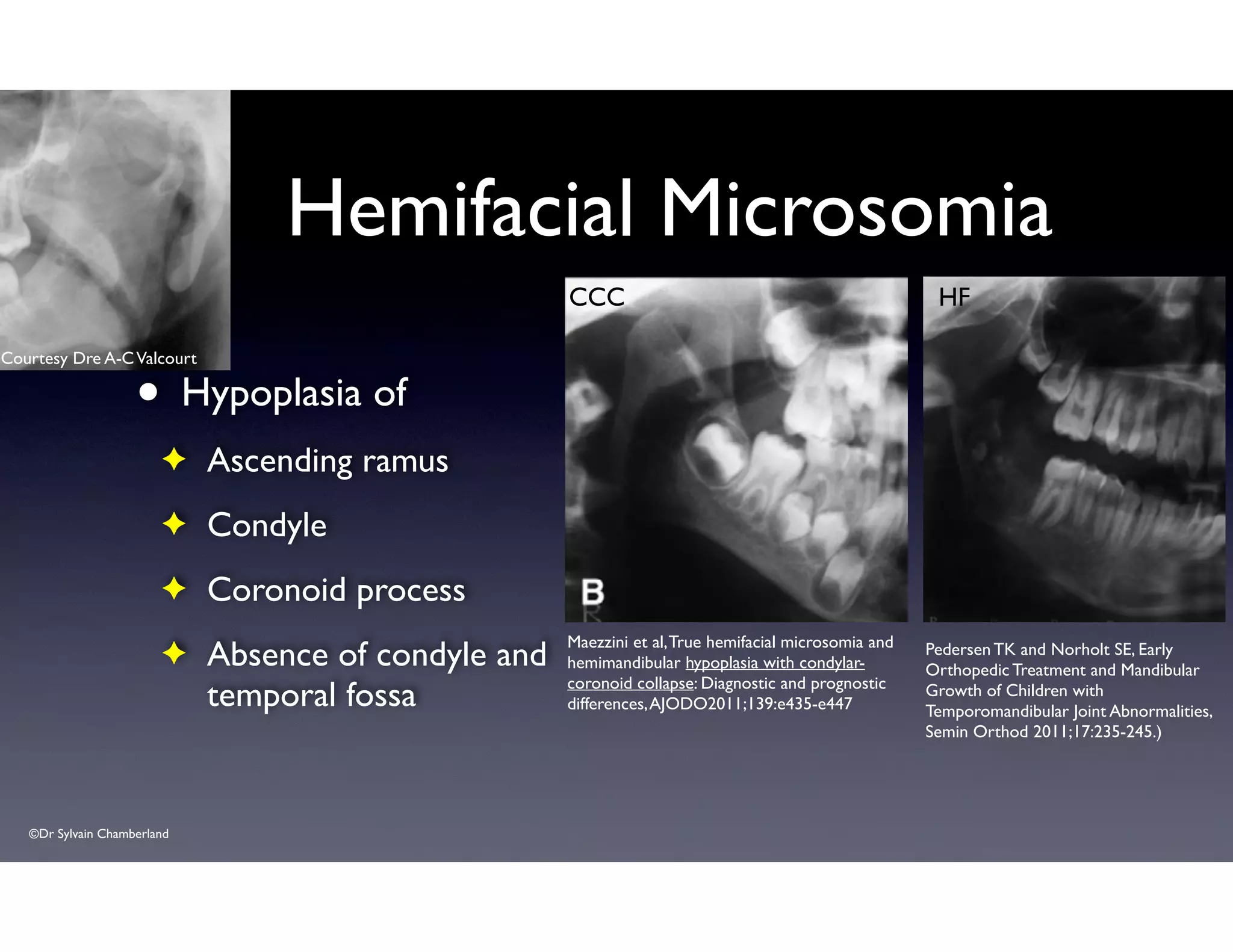 Hemimandibular hyperplasia and facial asymmetry | PDF