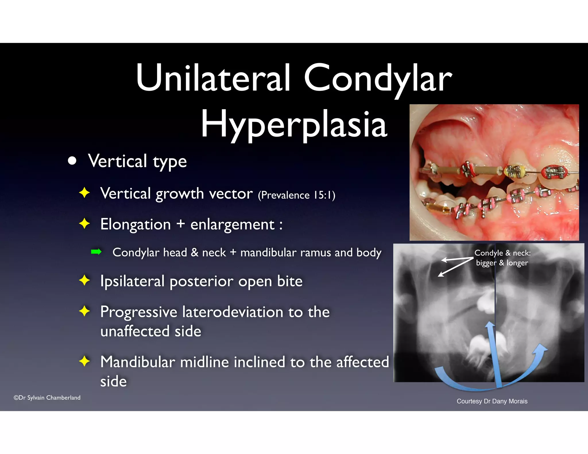 Hemimandibular hyperplasia and facial asymmetry | PDF