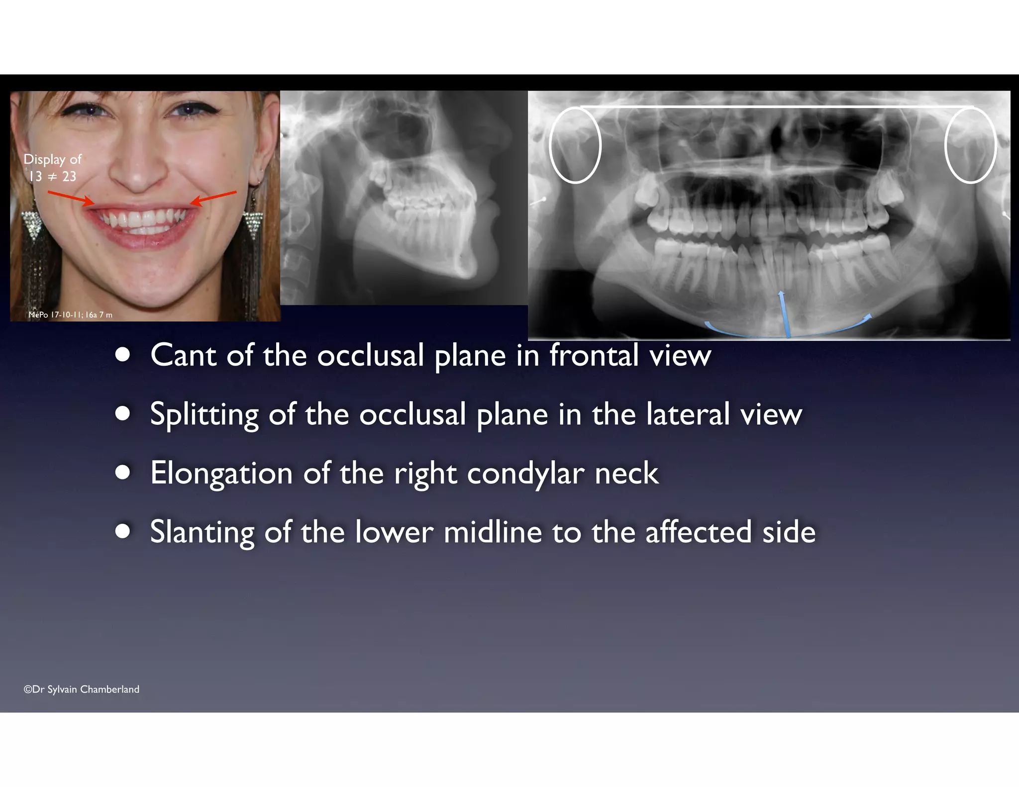 Hemimandibular hyperplasia and facial asymmetry | PDF