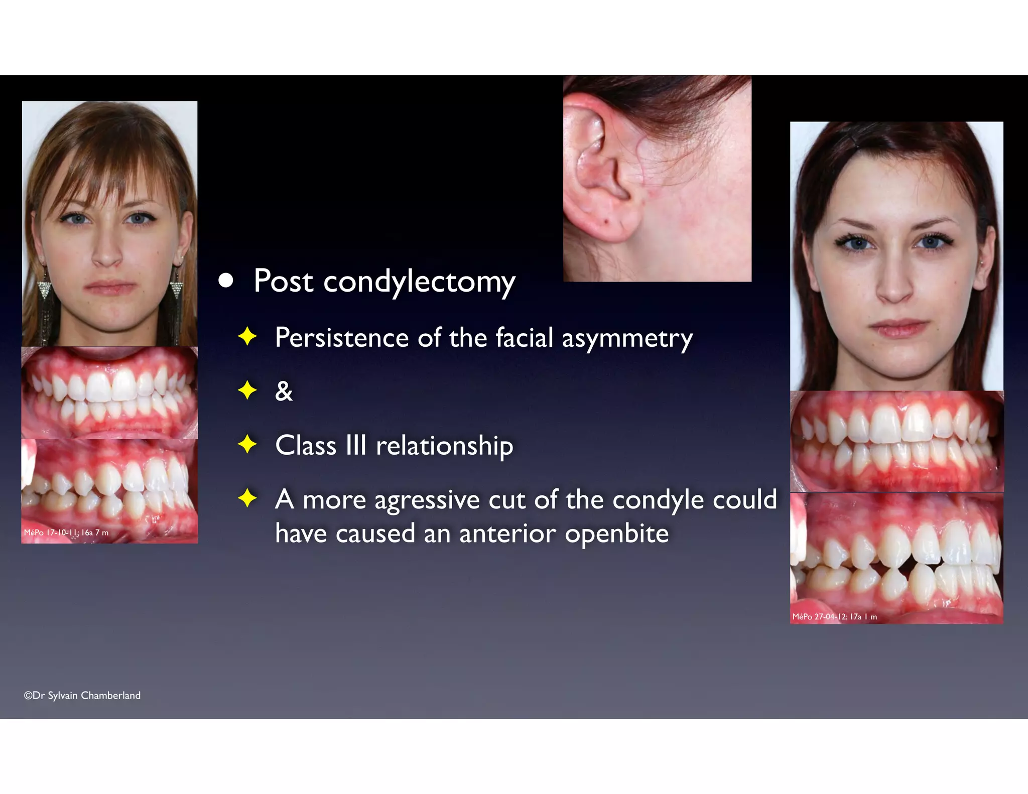 Hemimandibular hyperplasia and facial asymmetry | PDF