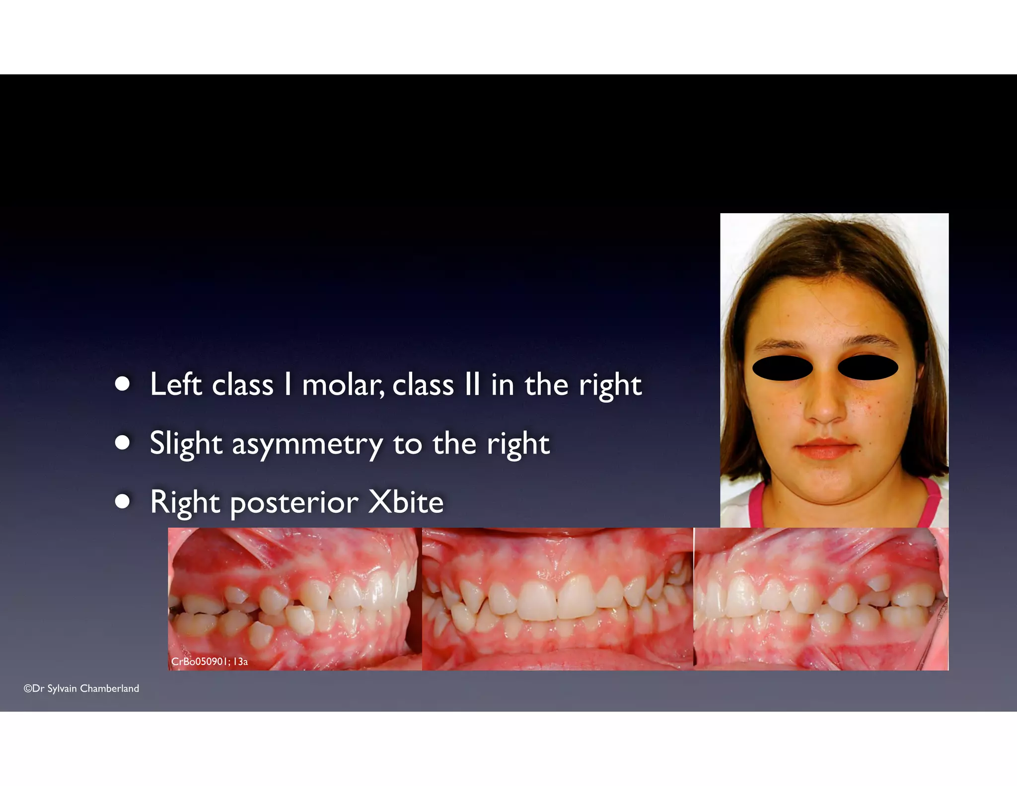 Hemimandibular hyperplasia and facial asymmetry | PDF