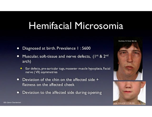 Hemimandibular Hyperplasia And Facial Asymmetry