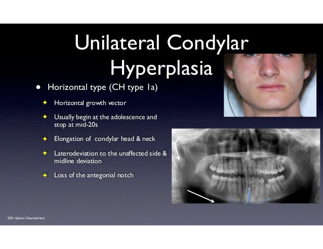 Hemimandibular hyperplasia and facial asymmetry