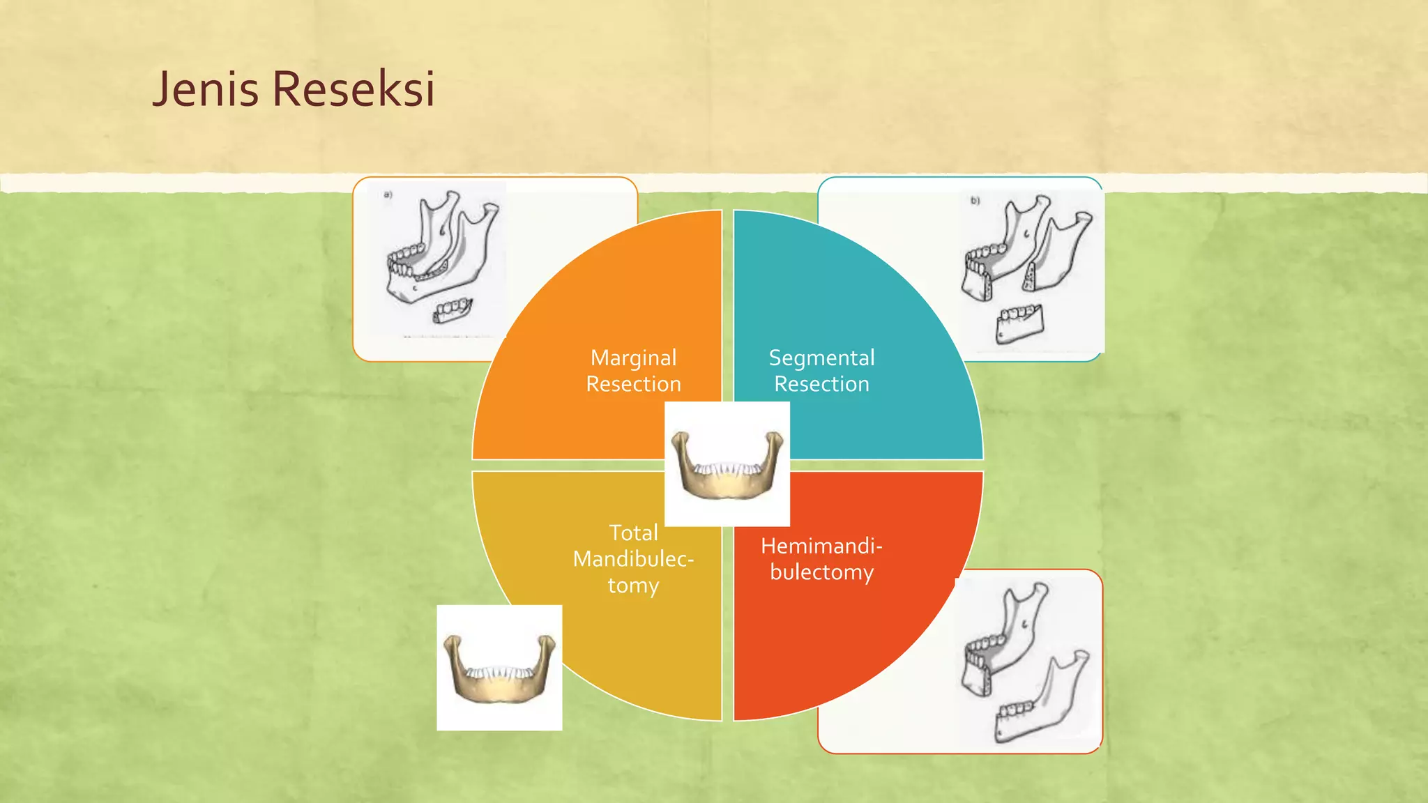 hemimandibulektomi.pptx