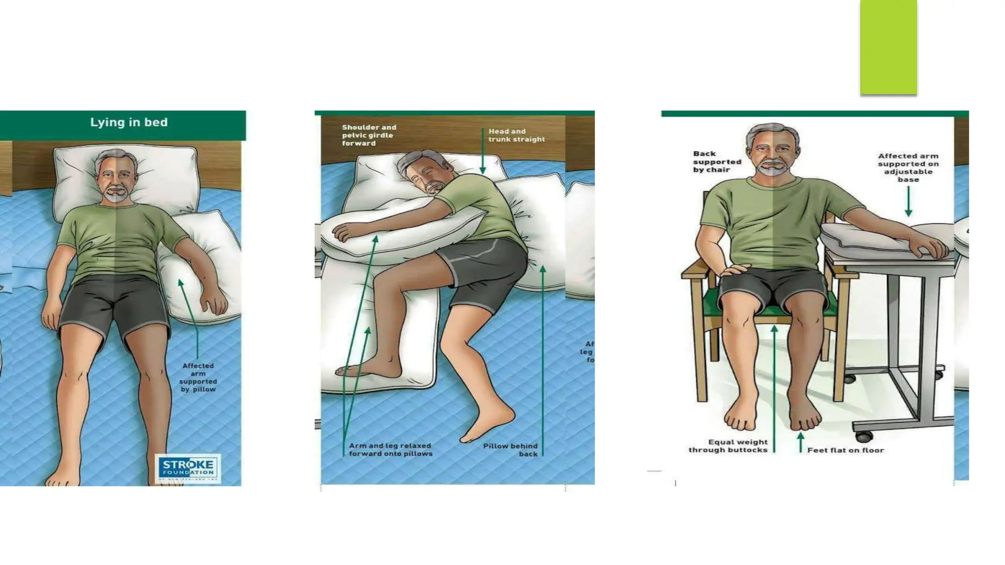 Hemiparesis - case presentation.pptx
