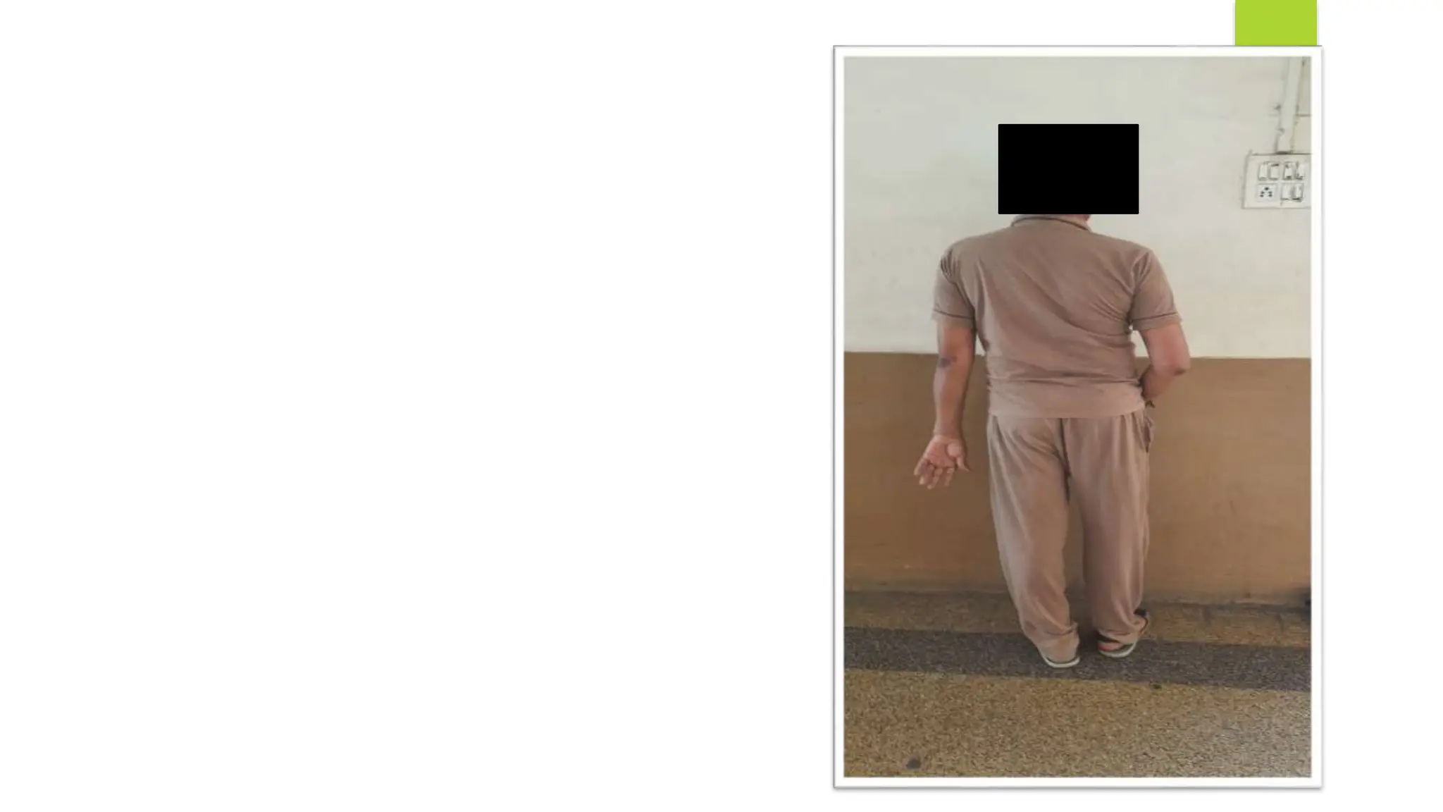 Hemiparesis - case presentation.pptx