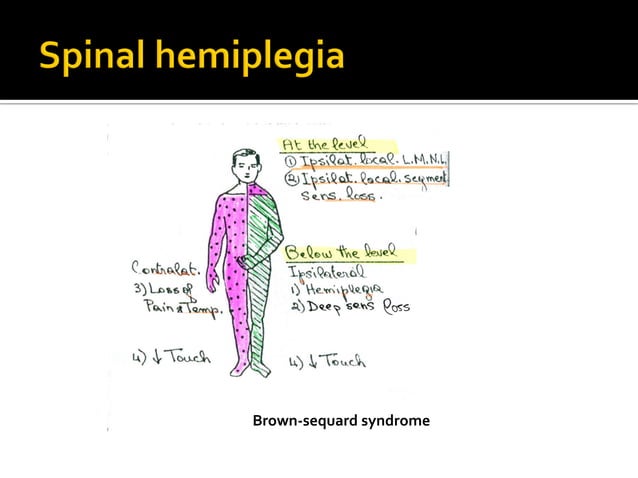 Hemiplegia