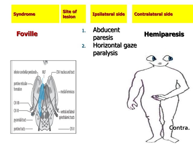 Hemiplegia