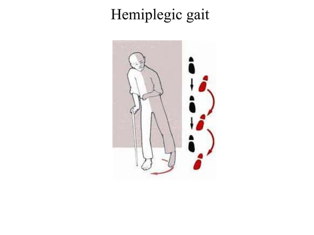 Hemiplegic gait | PPTX | Physical Therapy | Wellness