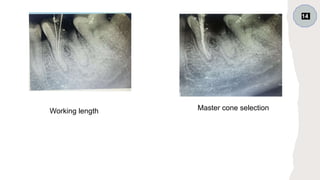 resection for conservation HEMISECTION.. | PPTX