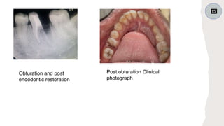 resection for conservation HEMISECTION.. | PPTX