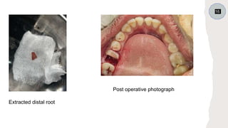 resection for conservation HEMISECTION.. | PPTX