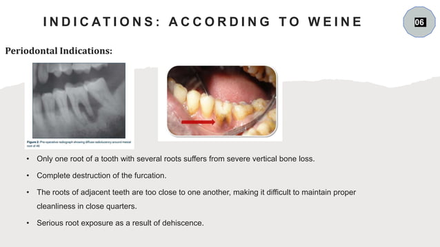 resection for conservation HEMISECTION.. | PPTX