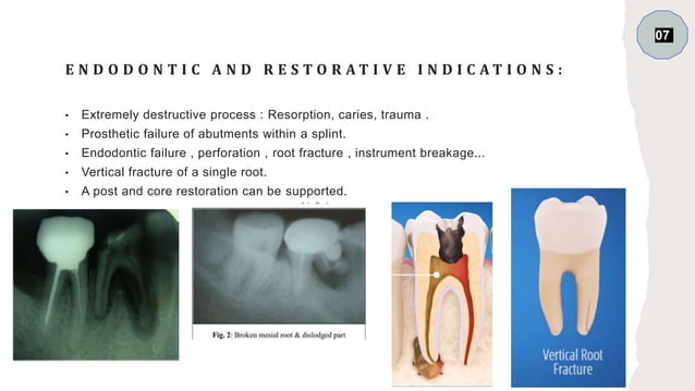 resection for conservation HEMISECTION.. | PPTX