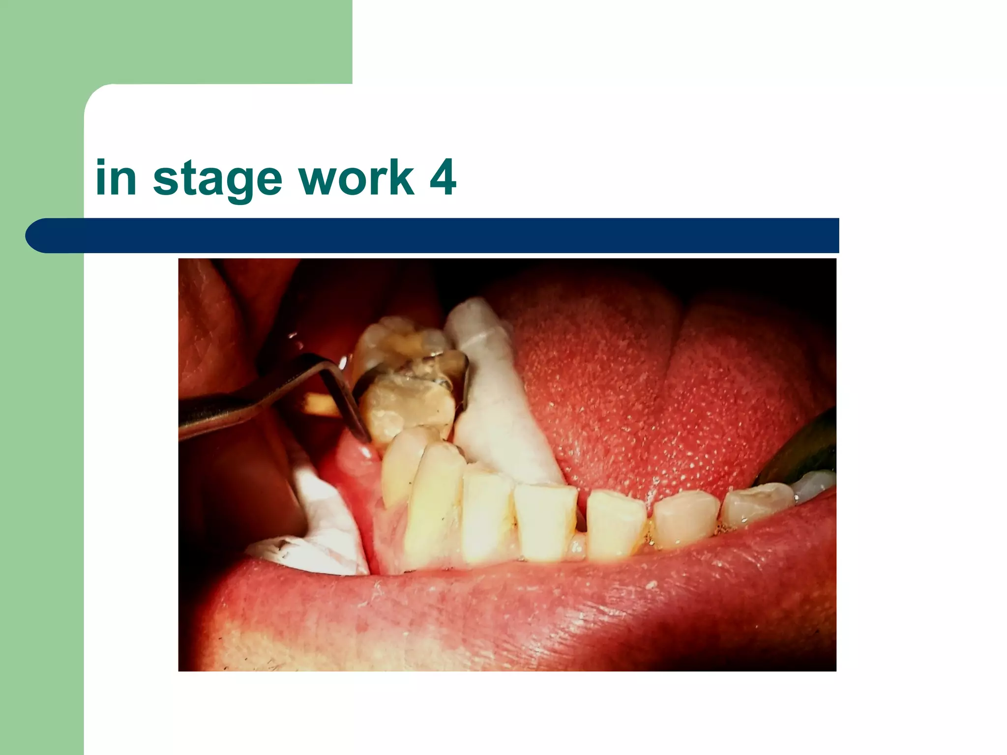 Hemisections teeth 46 | PPT