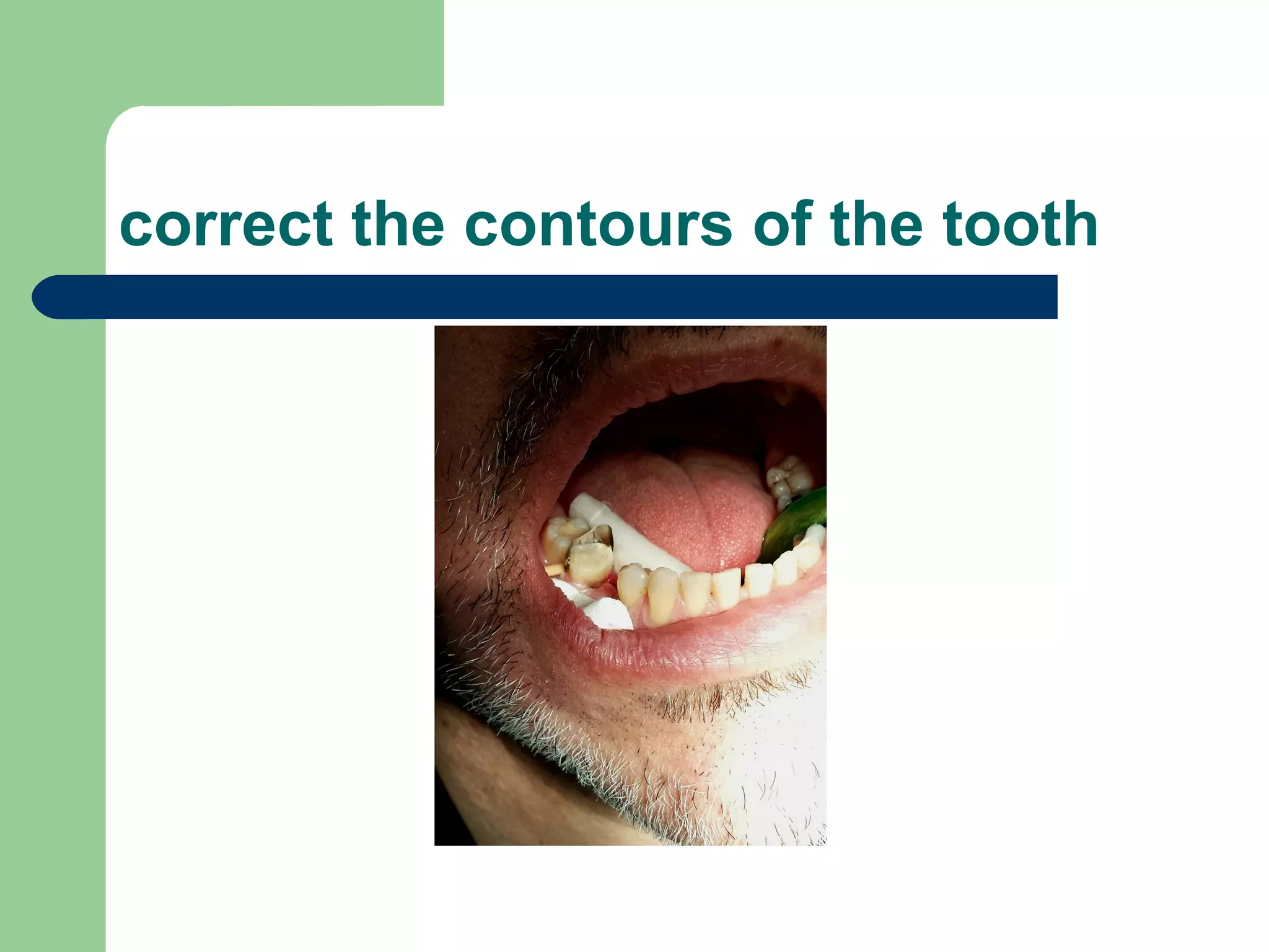 Hemisections teeth 46 | PPT | Free Download