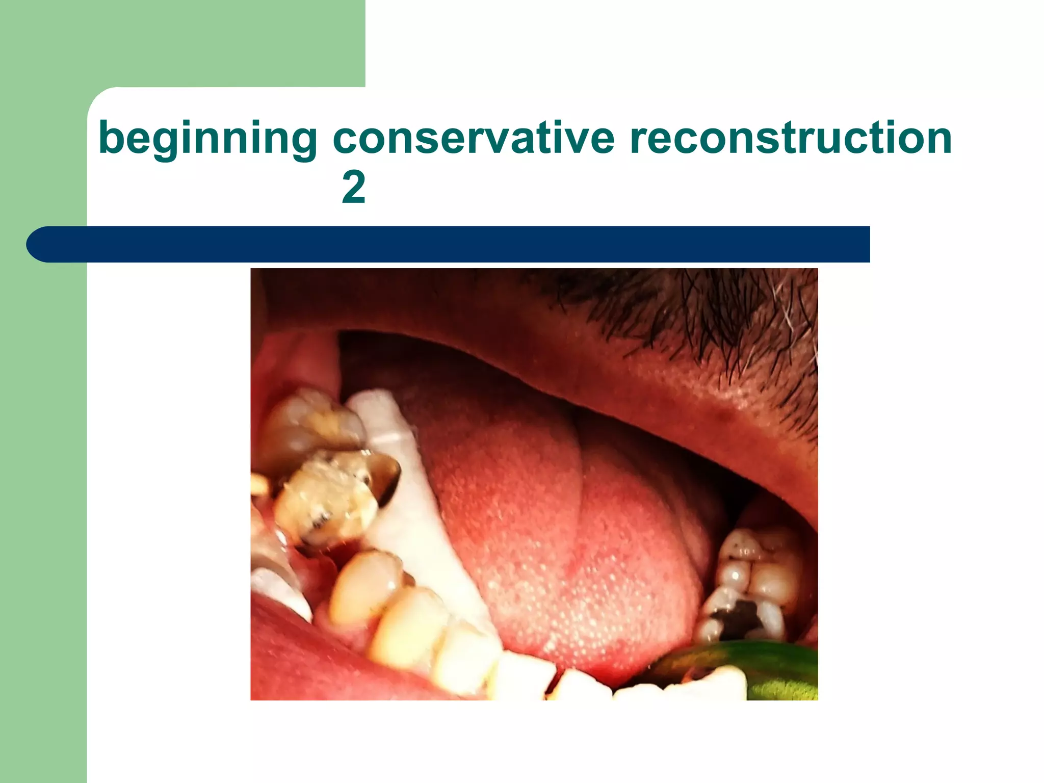 Hemisections teeth 46 | PPT