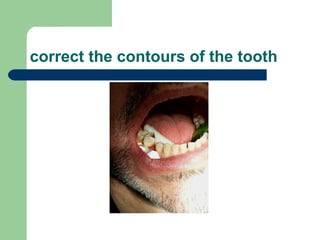Hemisections teeth 46 | PPT