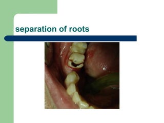 Hemisections teeth 46 | PPT