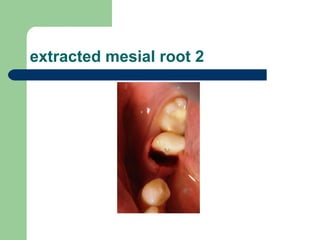Hemisections teeth 46 | PPT