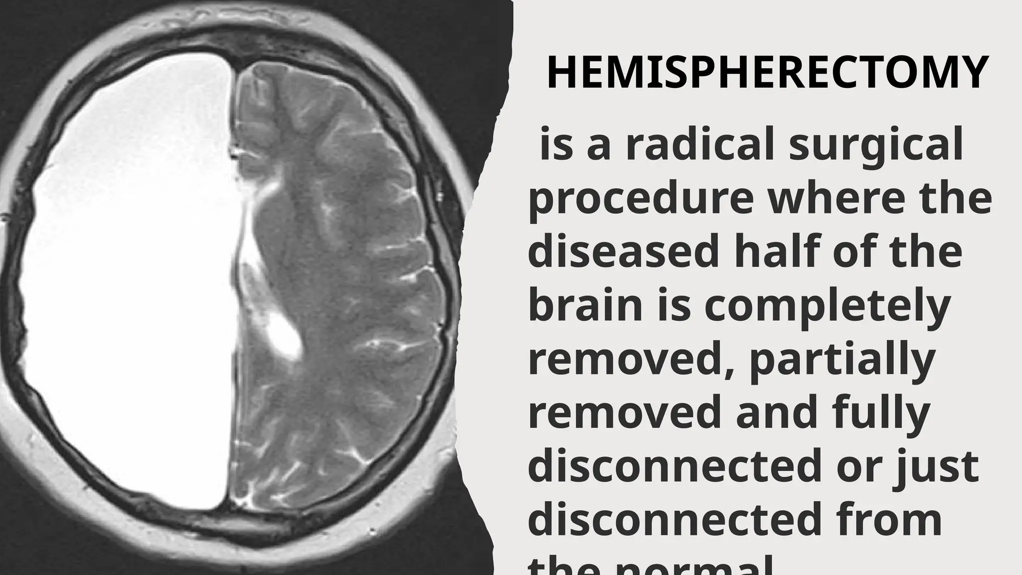 Gen. Biology Trivia Hemispherectomy.pptx