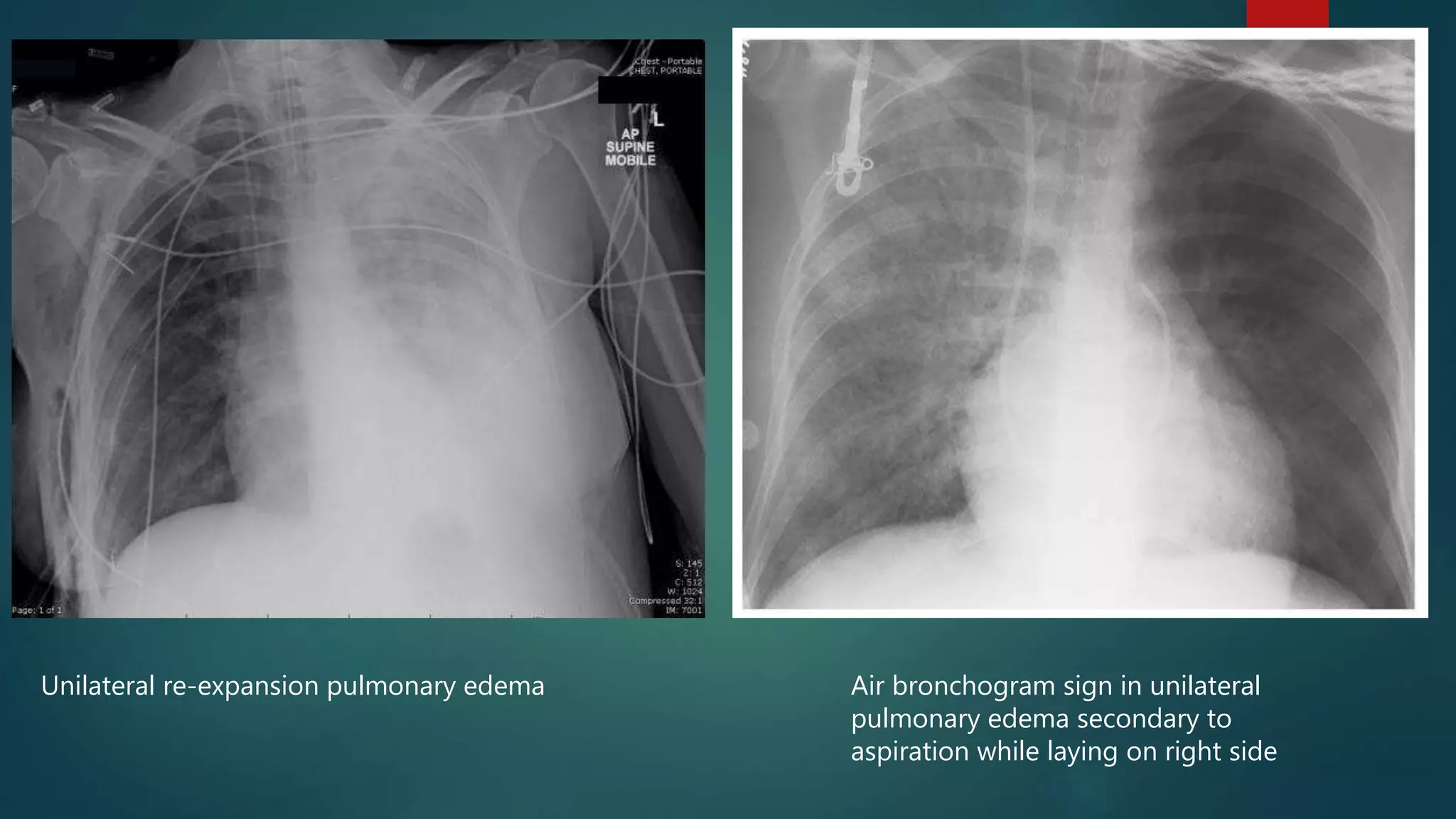 Hemithorax white out (1) | PPTX