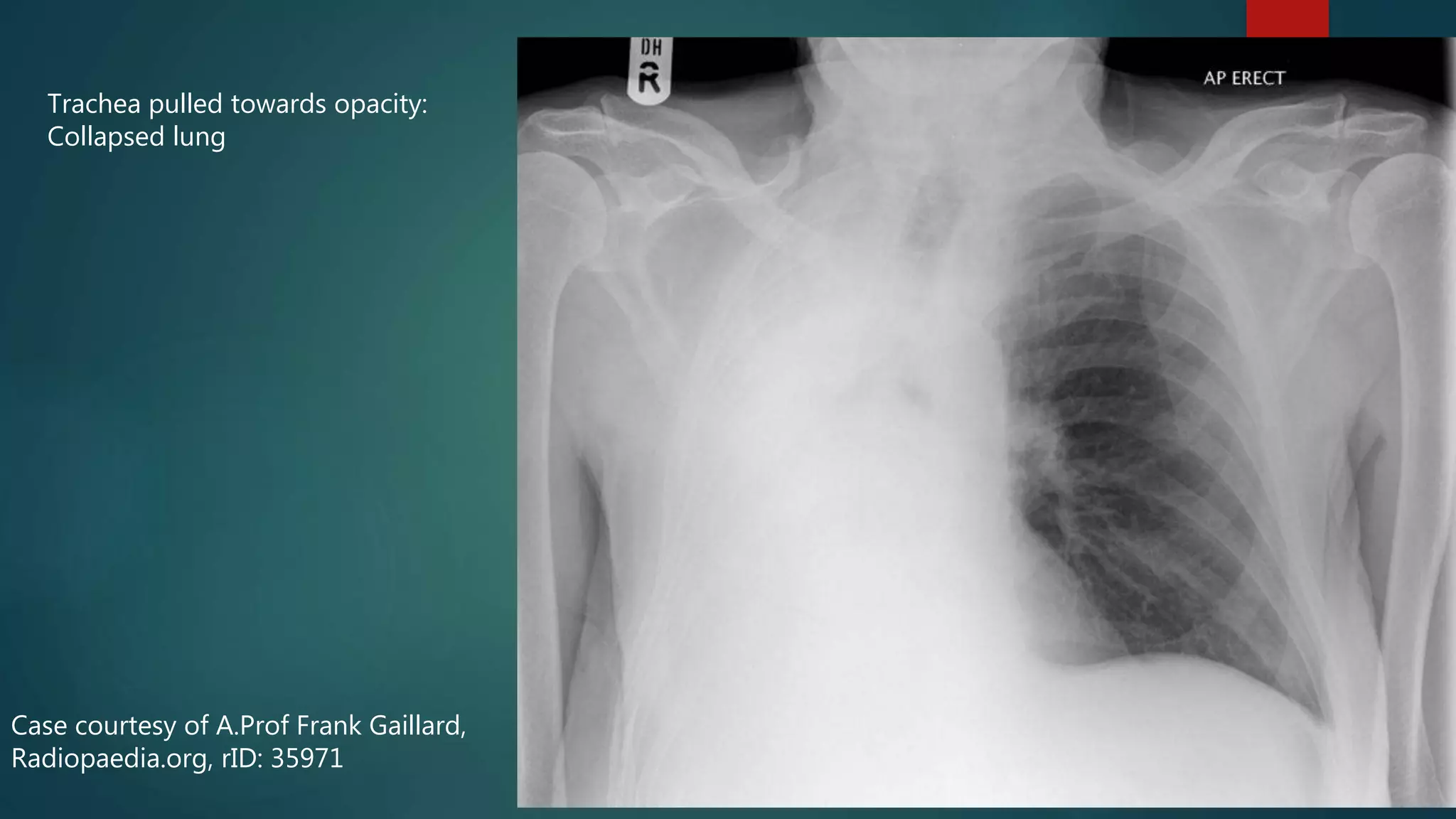 Hemithorax white out (1) | PPTX