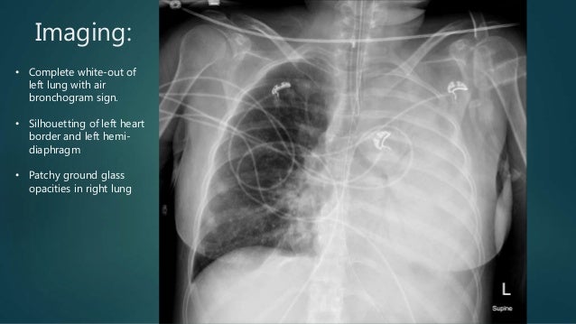 Hemithorax white out (1)