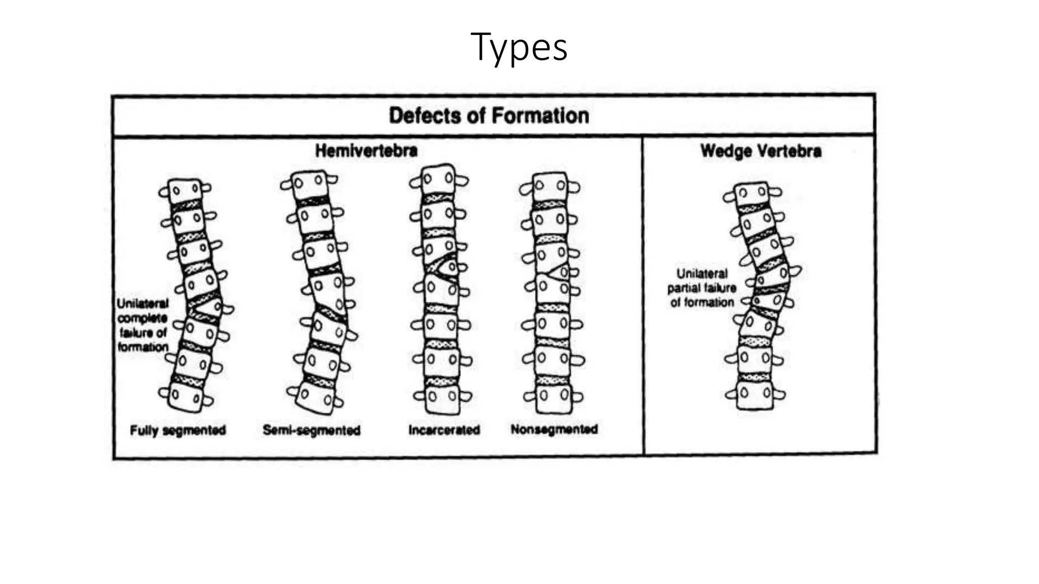 Hemivertebra.pptx