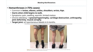 hemo and platelet disorder in hematology | PPTX