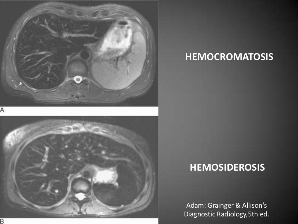 Hemocromatosis