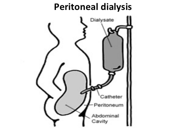 Fistula Dialysis Hemodialysis Av Kidney Shunt Arteriovenous Fissure ...