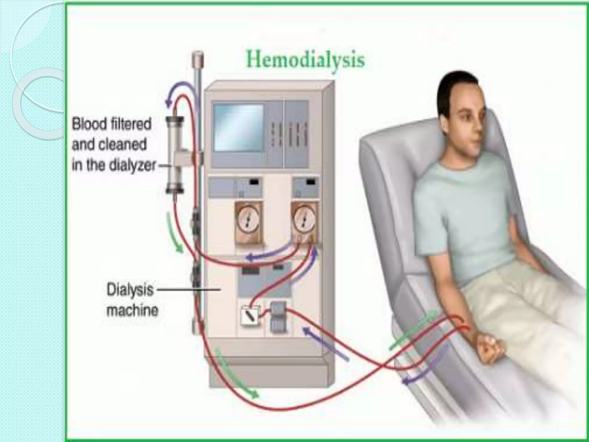 Hemodialysis | PPTX
