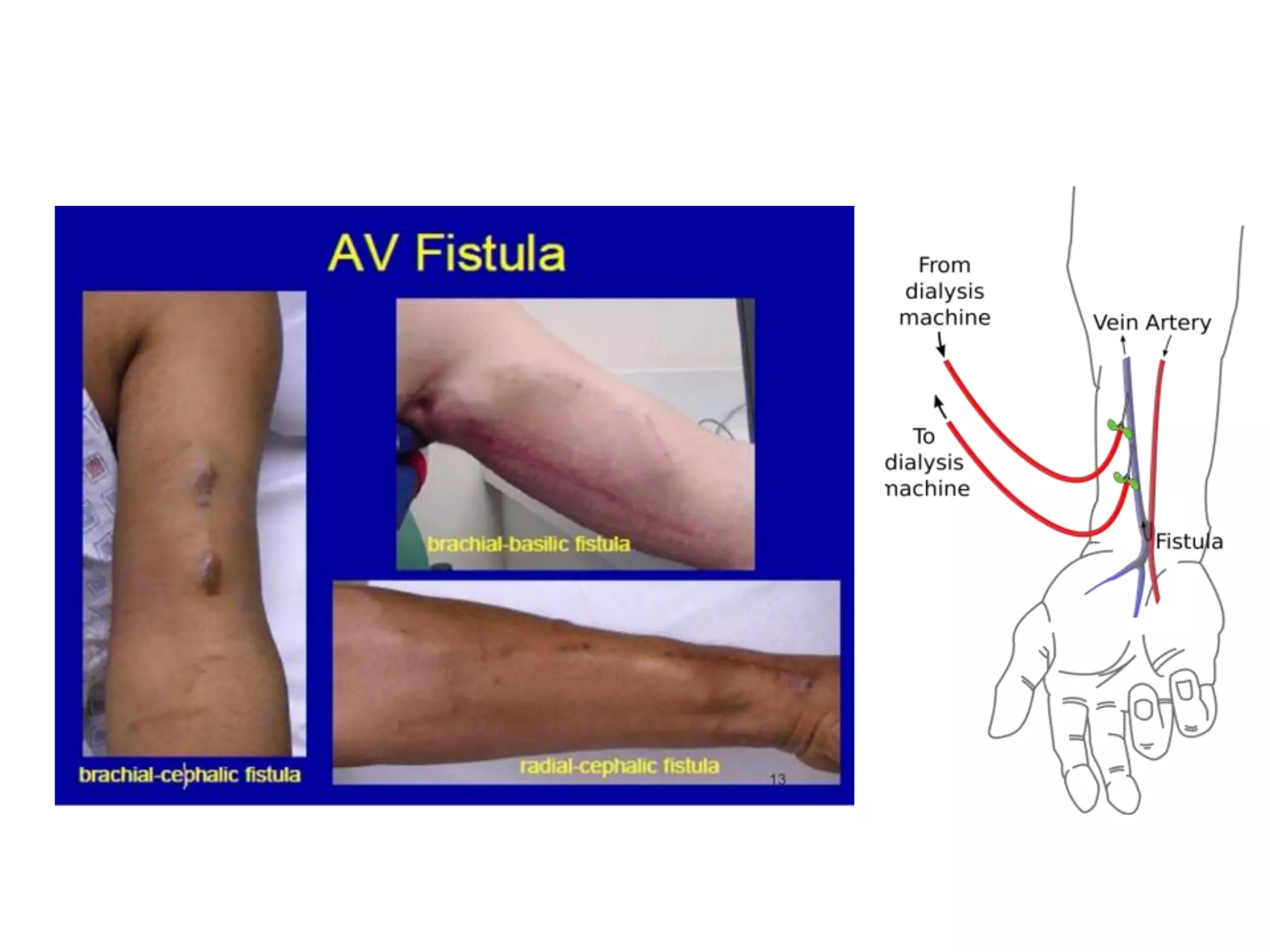 Hemodialysis: management of chronic kidney disease | PPTX