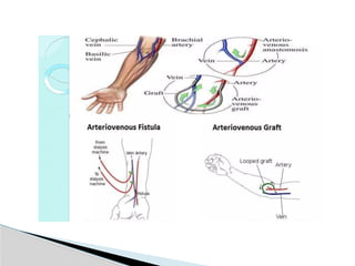 Hemodialysis definition and causes .pptx