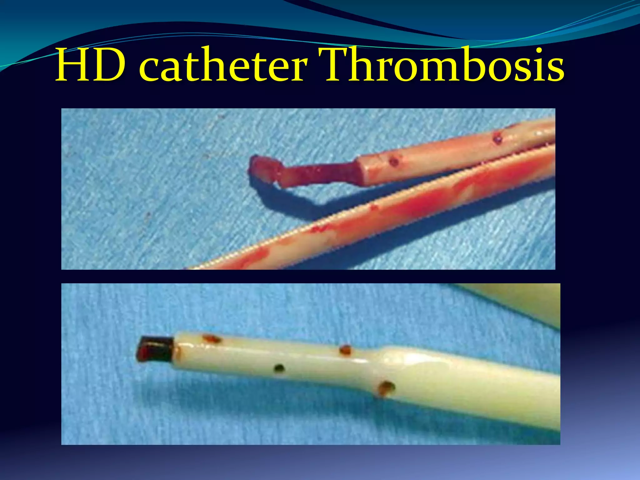 Hemodialysis vascular catheters review | PPTX