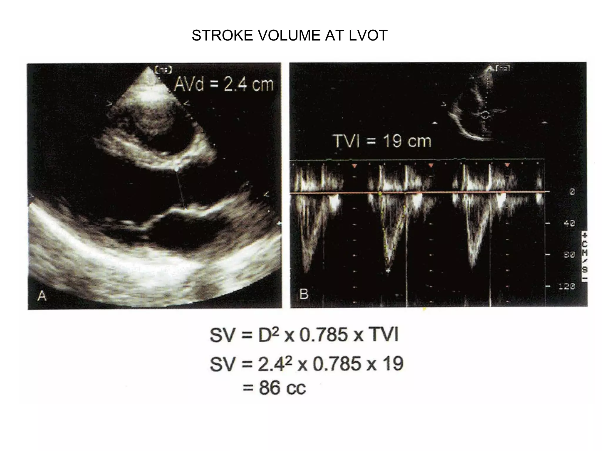 Hemodynamic Assessment by Echocardiography | PPT