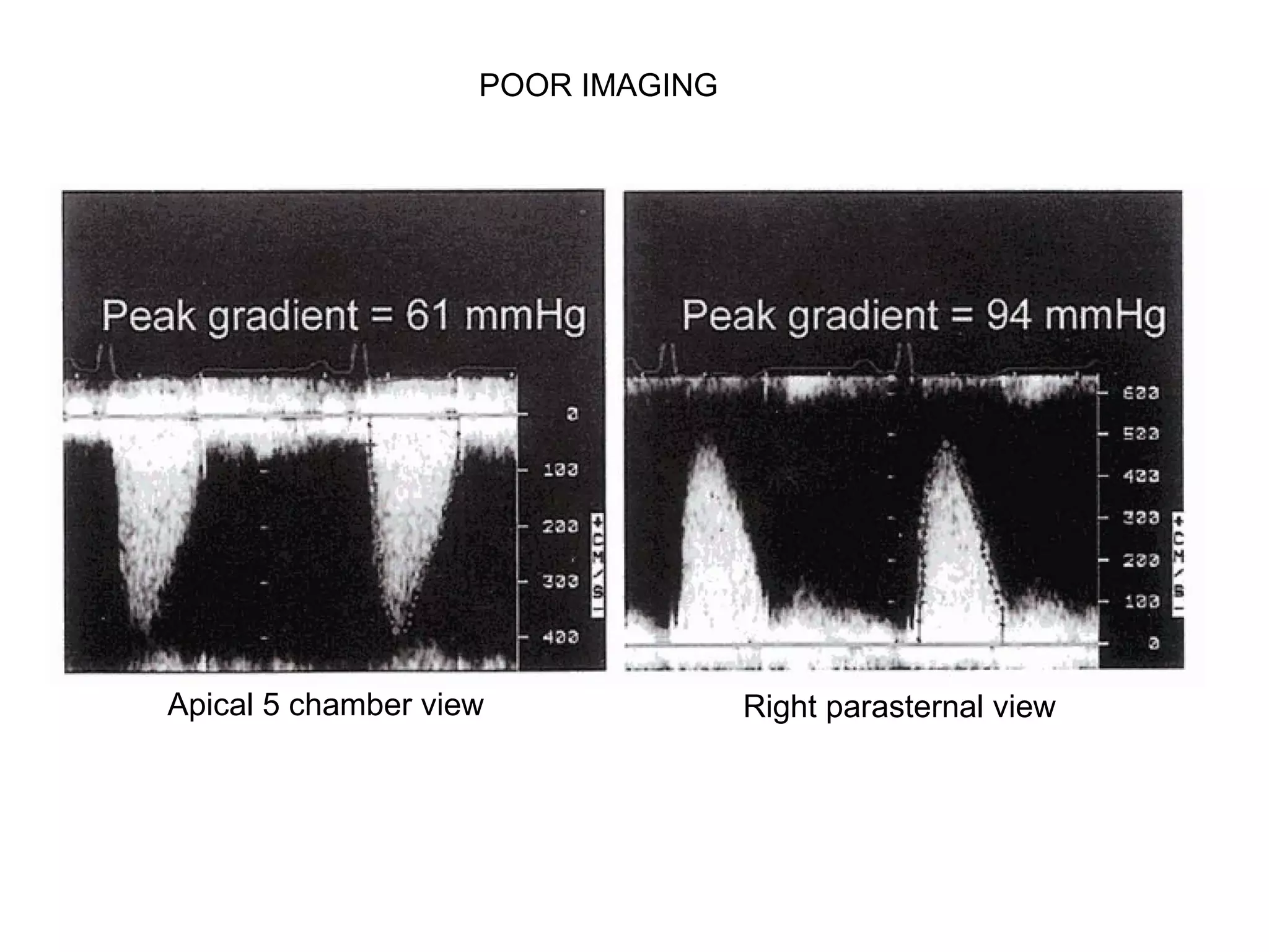 Hemodynamic Assessment by Echocardiography | PPT